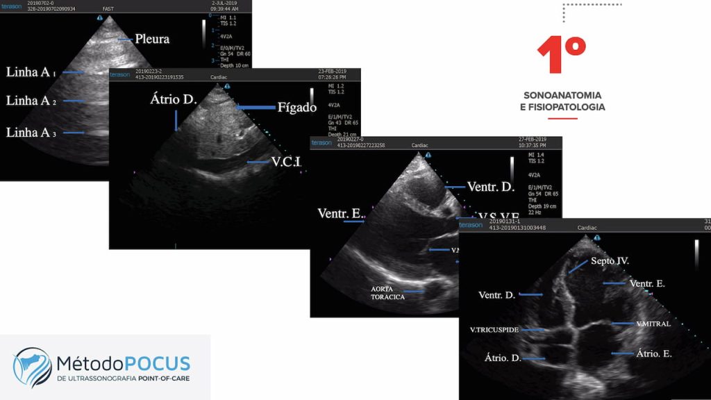 Guia Prático de Ultrassonografia Point-of-Care (POCUS)